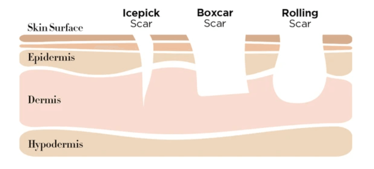 Acne scars. Types and treatments - Hush LA Medspa