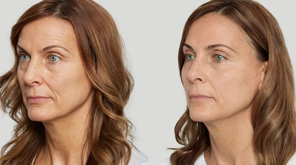 How to boost collagen production with Sculptra - Hush LA Medspa