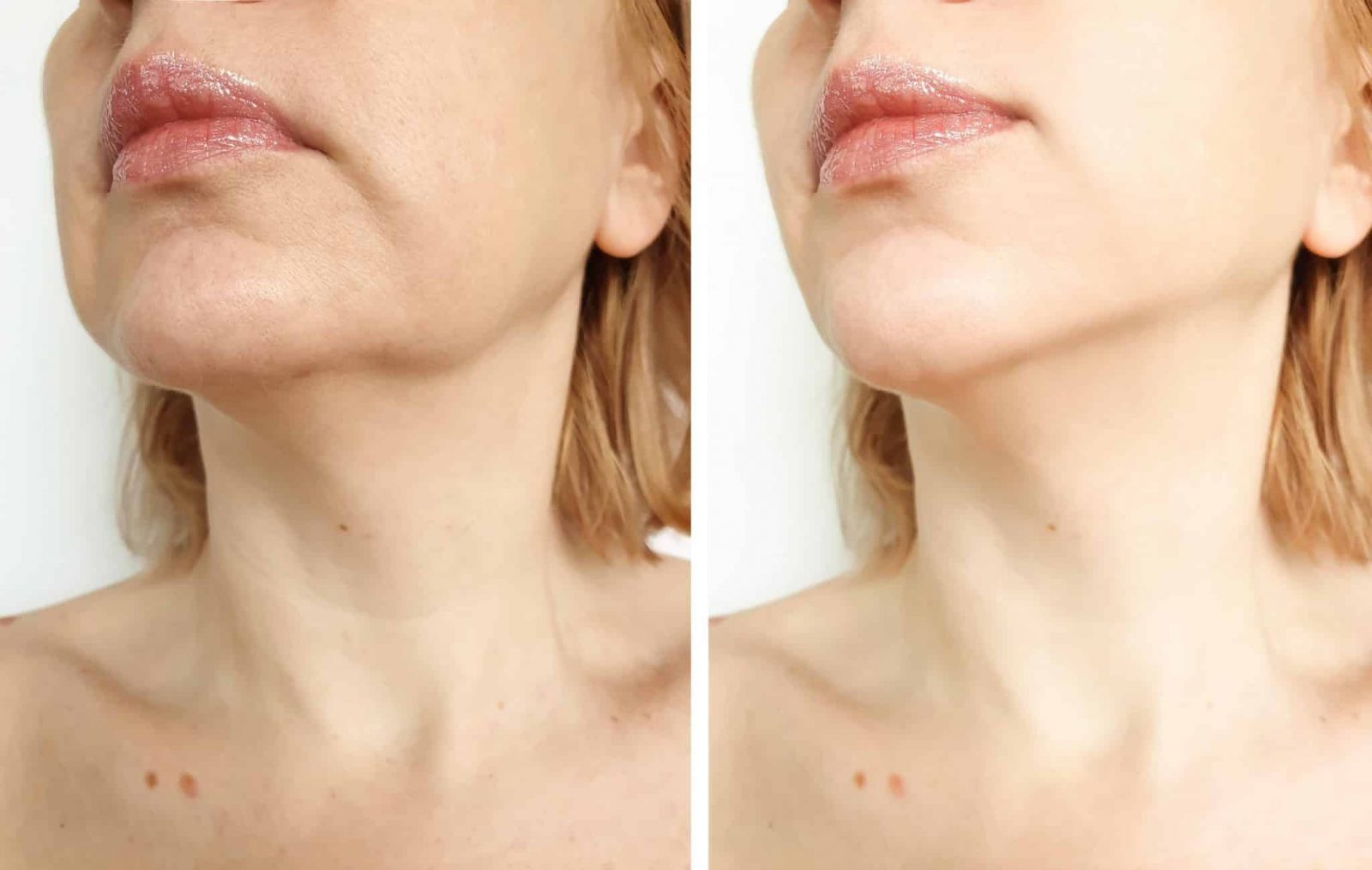 6 procedures for sagging skin treatment - Hush LA Medspa