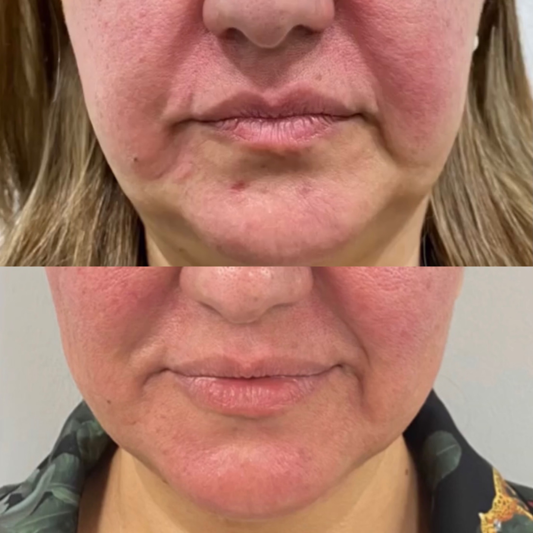 8 best non-surgical skin tightening treatments for firmer skin - Hush ...