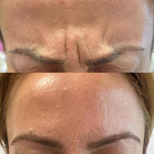 Erase the years. Effective treatments for glabellar lines - Hush LA Medspa