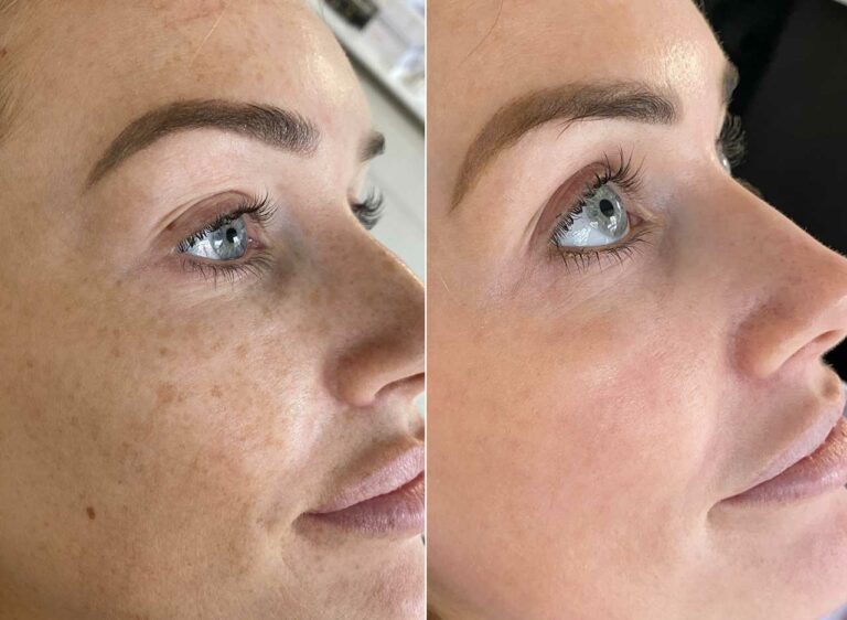 Under-eye hollows. Non-surgical solutions for sunken eyes - Hush LA Medspa