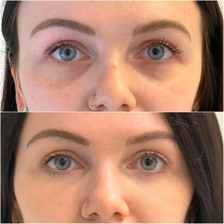 Under-eye hollows. Non-surgical solutions for sunken eyes - Hush LA Medspa