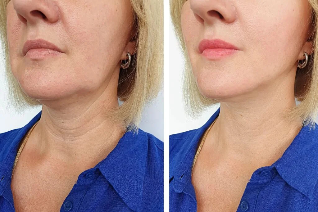 Say goodbye to sagging skin. Morpheus8 neck lift benefits - Hush LA Medspa