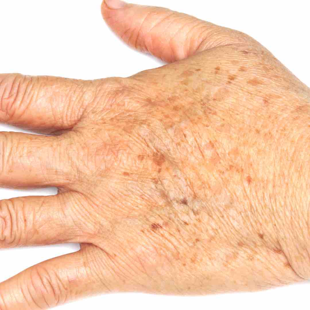 The best remedies for dark patches on skin - Hush LA Medspa