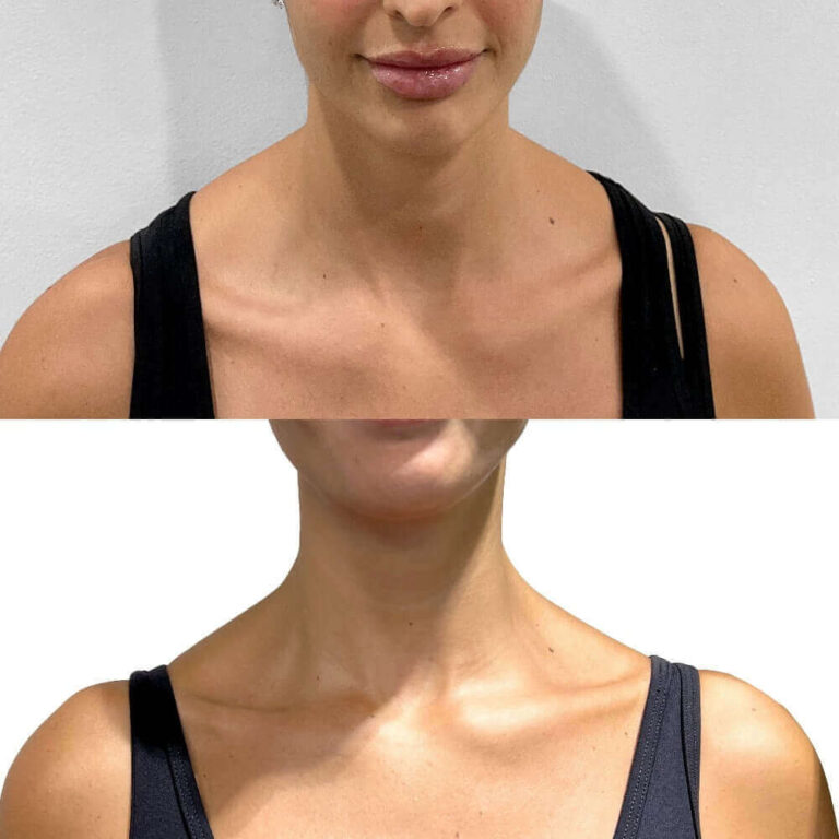 Sculpt your upper torso with a Barbie Botox injection - Hush LA Medspa