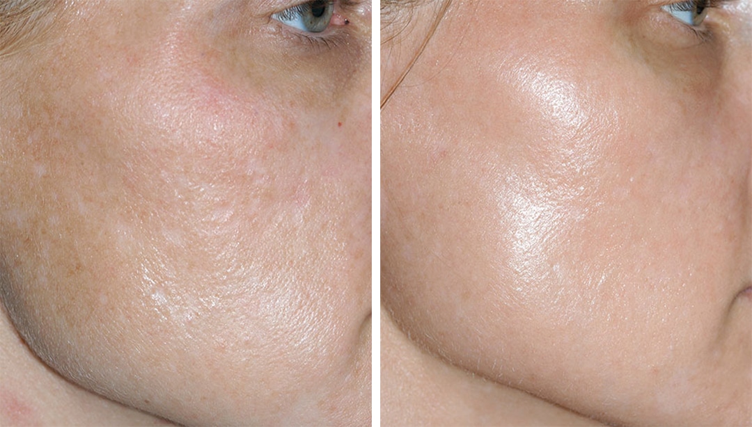 Tackling uneven skin texture with Morpheus8 - Hush LA Medspa