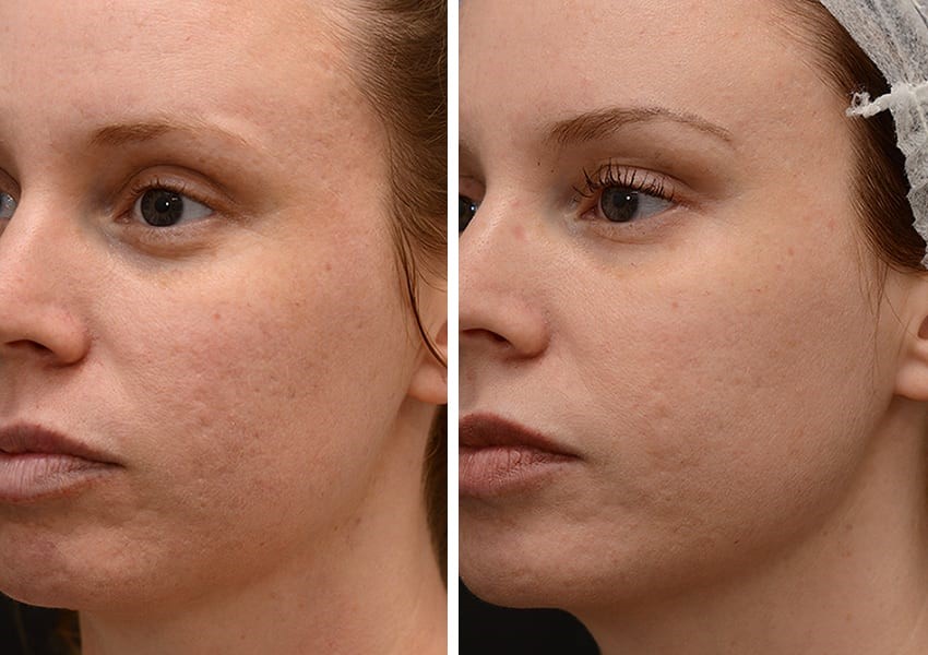 9 Treatments for Scars on Face at Hush LA Medspa