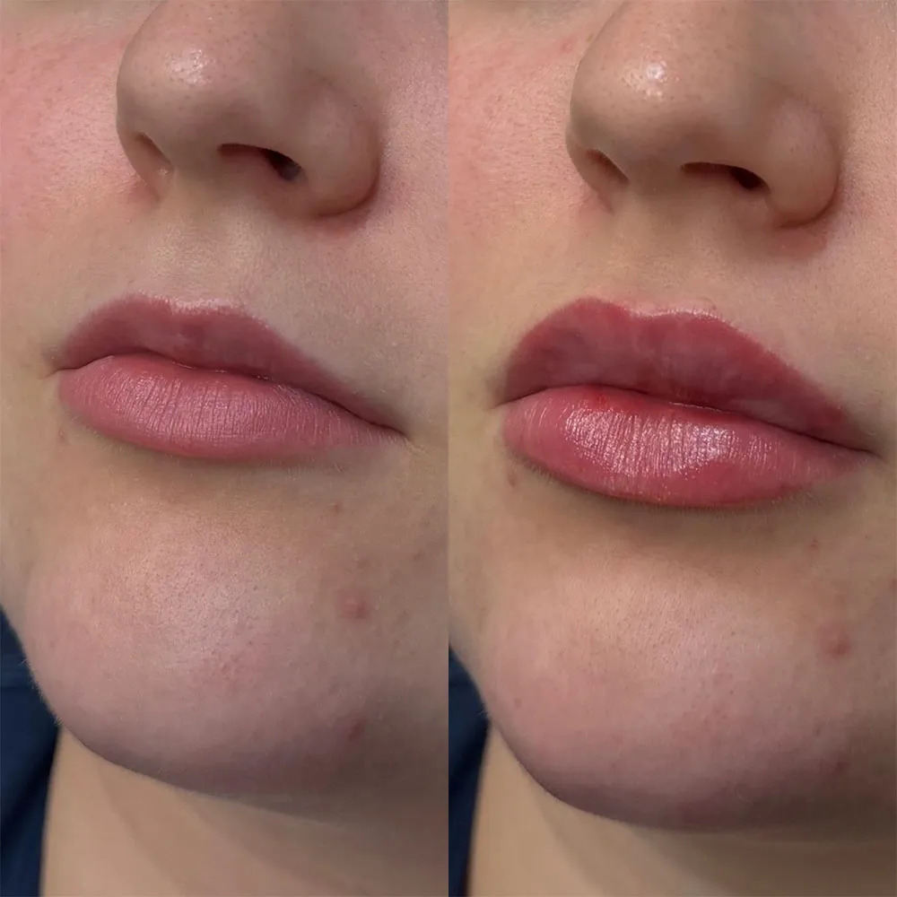 What You Need to Know About Lip Fillers | Hush LA Medspa
