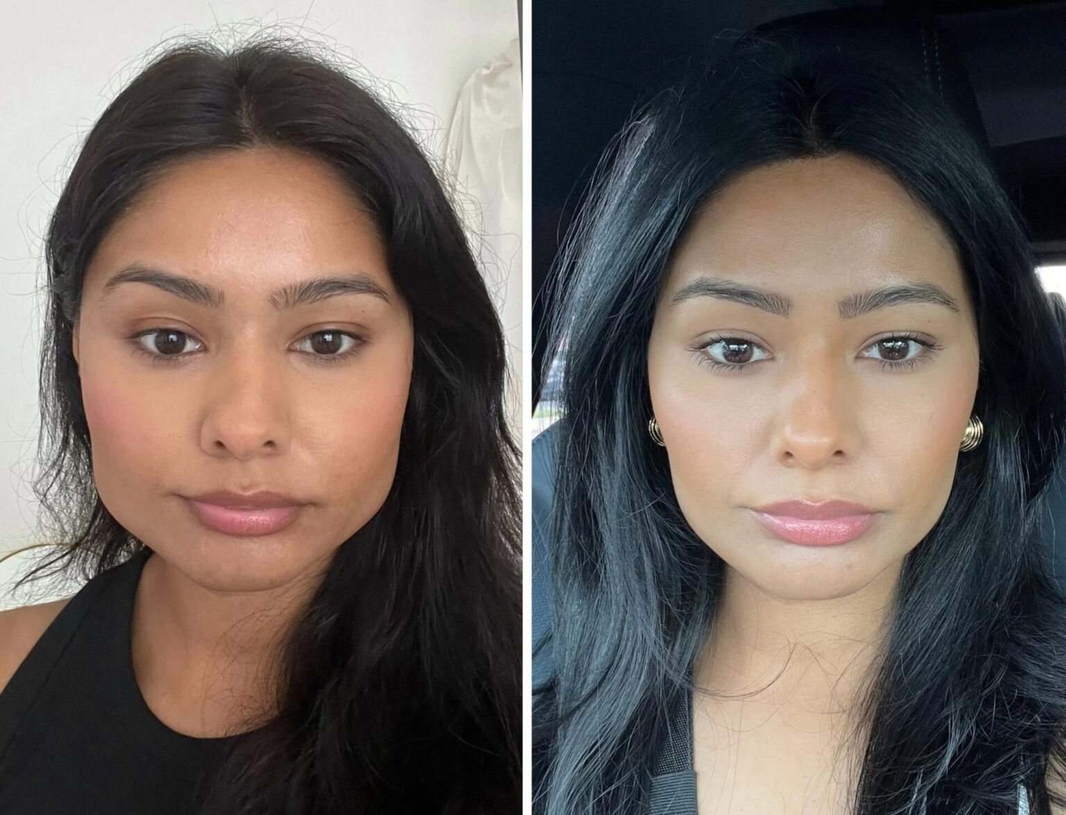 Jaw Botox for facial contouring and TMJ relief - Hush LA Medspa