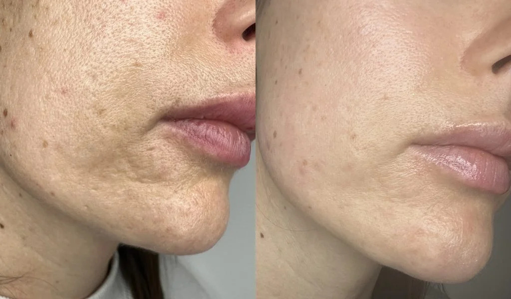 Targeting enlarged pores with Coolpeel technology - Hush LA Medspa