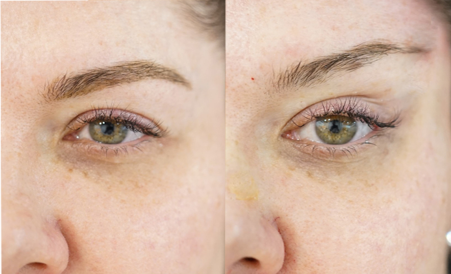 A modern approach to eye-lifting: Why PDO threads stand out - Hush LA ...